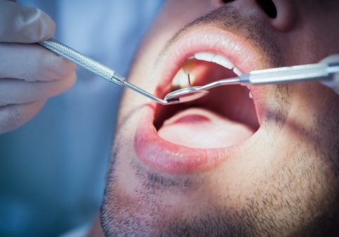 Gum Lift – Leven Dental and Implant Centre